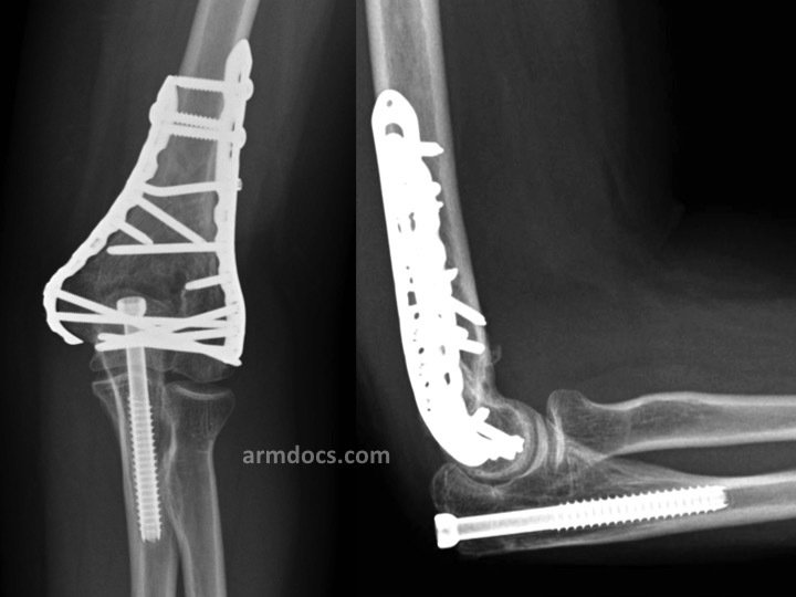 Distal Humerus Fracture Fixation | Arm Docs