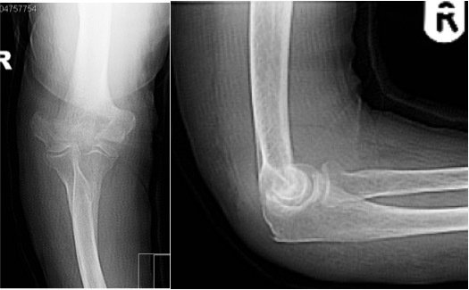 Elbow Hemiarthroplasty | Arm Docs