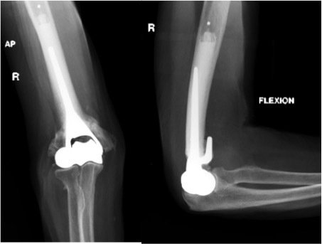 Elbow Hemiarthroplasty | Arm Docs
