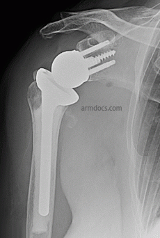 Proximal humerus fracture - Reverse Shoulder Replacement | Arm Docs