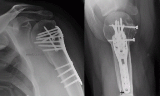 Proximal Humerus Fracture - Operative Fixation | Arm Docs