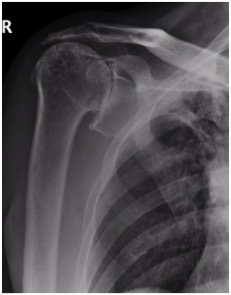 Reverse Shoulder Replacement | Arm Docs