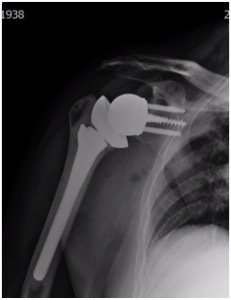 Reverse Shoulder Replacement | Arm Docs