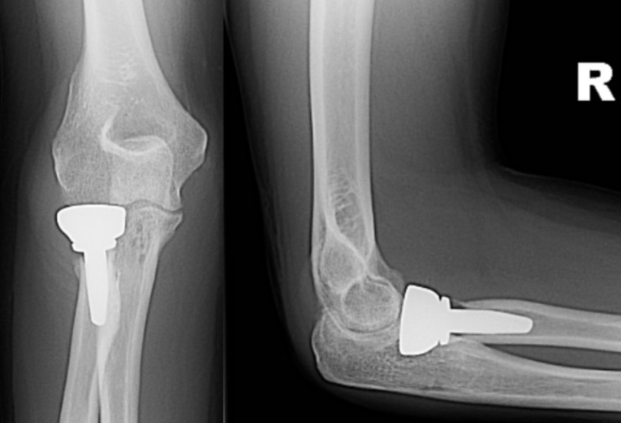Radial Head Replacement | Arm Docs